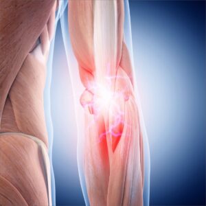 Medial Epicondylitis - Los Angeles, CA - Dr. Jason Snibbe