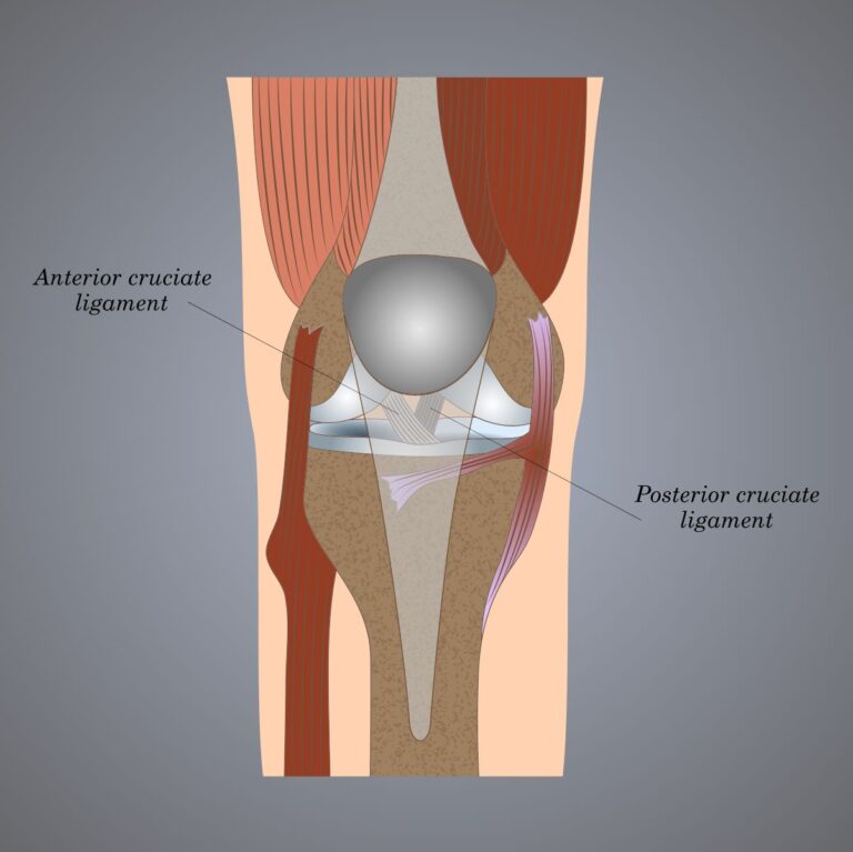 Arthroscopic ACL Reconstruction - Los Angeles, CA - Dr. Jason Snibbe
