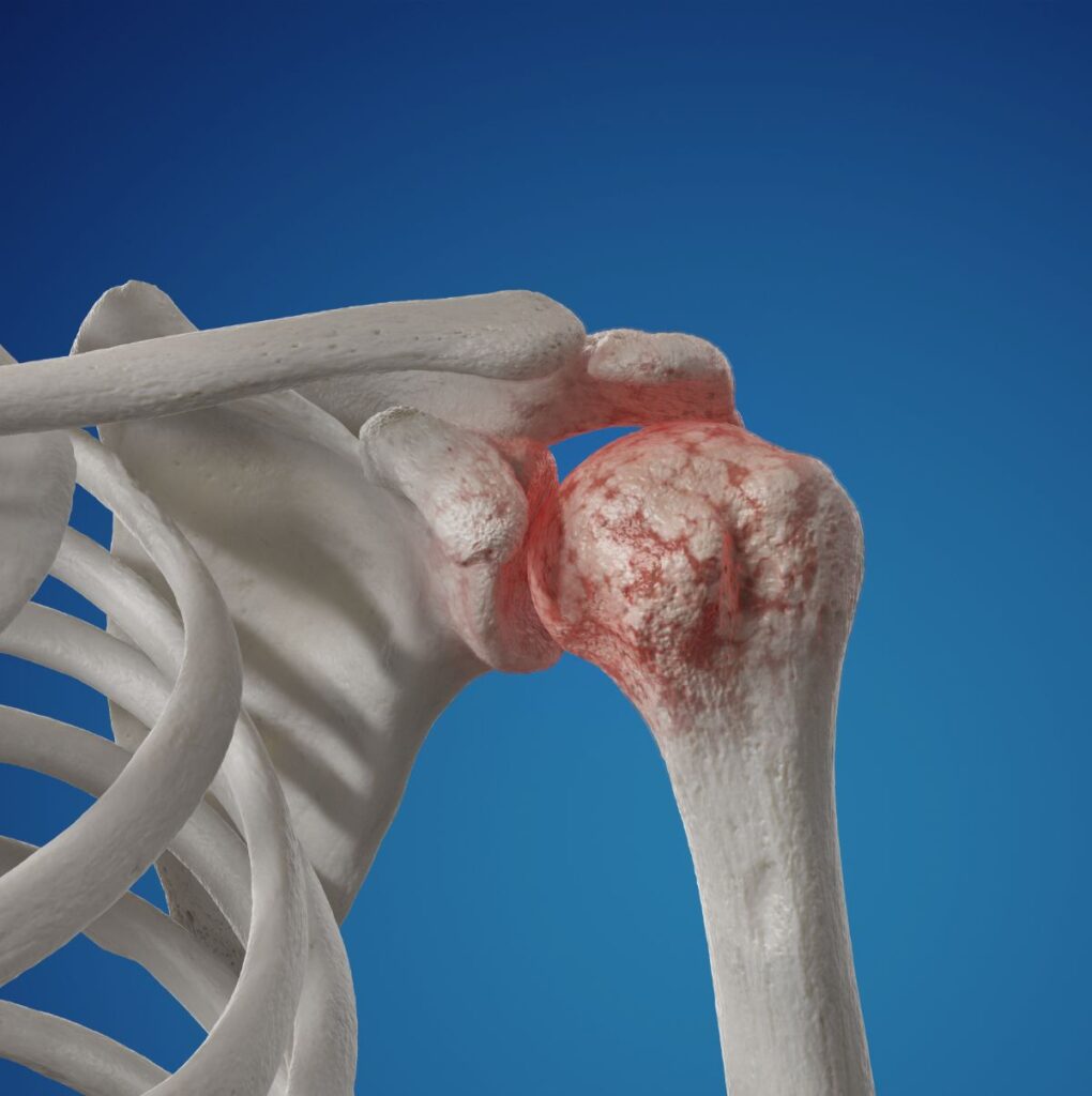 Osteoarthritis OA Of The Shoulder Los Angeles CA Dr Jason Snibbe