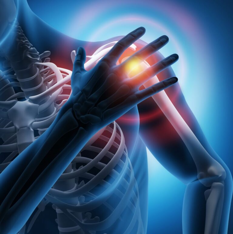 Adhesive Capsulitis - Los Angeles, CA - Dr. Jason Snibbe