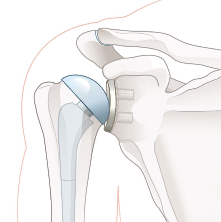 Robotic Total Shoulder Arthroplasty - Los Angeles, CA - Dr. Jason Snibbe
