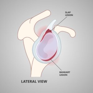 SLAP / Labrum Tear - Los Angeles, CA - Dr. Jason Snibbe