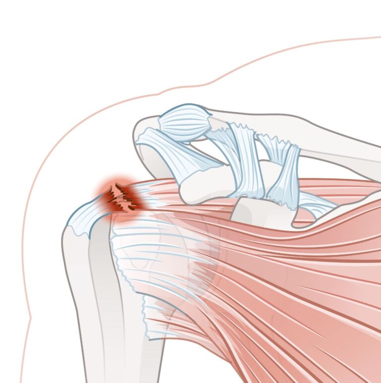 Biceps Tendon Rupture at Shoulder - Los Angeles, CA - Dr. Jason Snibbe