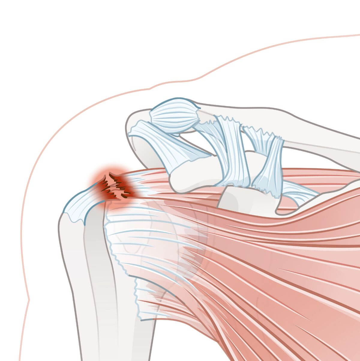 Biceps Tendon Rupture at Shoulder - Los Angeles, CA - Dr. Jason Snibbe
